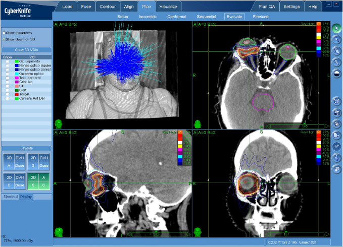 Radiosurgery Archives | Accuray Exchange